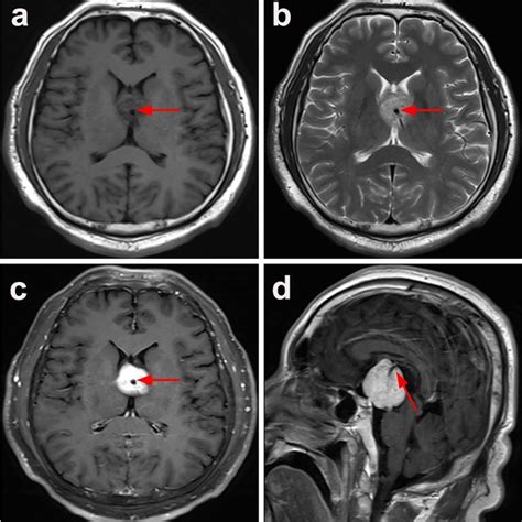 Brain Magnetic Resonance Imaging Showing Flow Void Within The Tumor Download Scientific