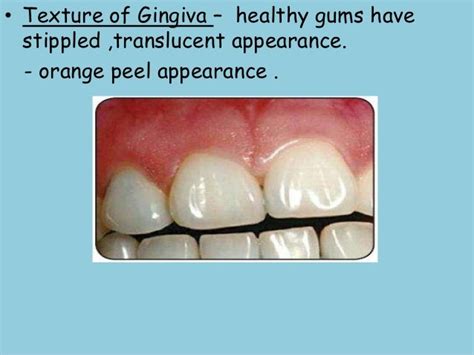 Clinical Features Of Gingiva