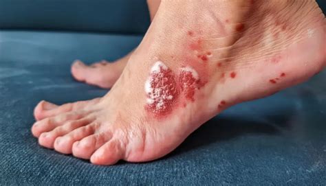 Cellulitis Foot
