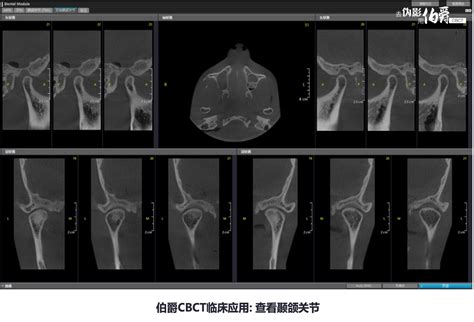 伯爵CBCT