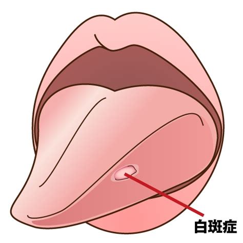 歯茎に白いできものができたら要注意！考えられる原因と対処法 Seekerシーカー