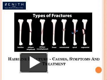 Hairline Fracture Causes Symptoms And Treatment Presentation Free