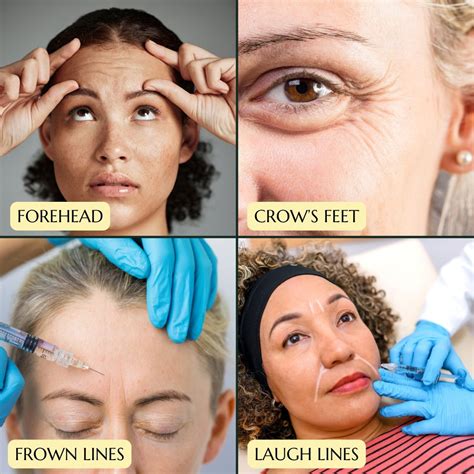 How Much Does Botox Cost A Detailed Guide