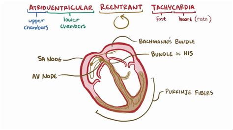 Video Atrioventricular Nodal Reentrant Tachycardia Avnrt Osmosis