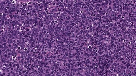 Sinonasal Undifferentiated Carcinoma Ottawa Atlas Of Pathology