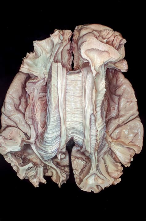 Superior View Of The Cingulum And Corpus Callosum Neuroanatomy The