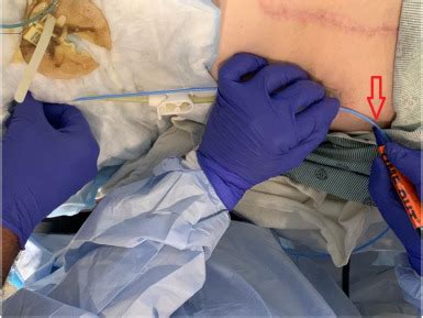 Two Endoscopic Suturing Techniques For The Prevention Of Percutaneous