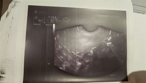 Разчитане на снимка от ехограф Бъдещи майки Страница 13 Мнения от Bg Mamma