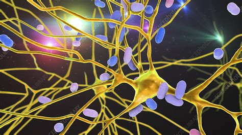 Bacterial Encephalitis Illustration Stock Image F030 7558 Science Photo Library