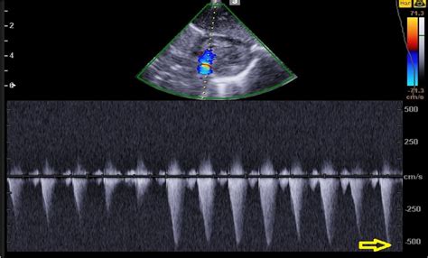 Doppler Spectral In Transthoracic Echocardiography Shows Severe Download Scientific Diagram