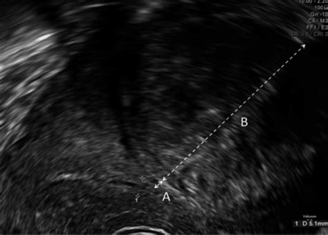 Ultrasound Mage Of An Intramural Subserous Fibroid Showing The Distance Download Scientific