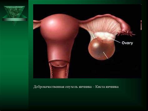 Доброкачественные и злокачественные опухоли яичников презентация онлайн