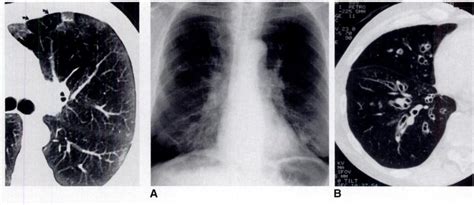 Bronchiolitis Obliterans