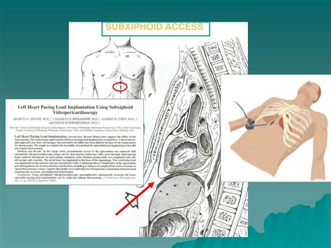 Ppt The Future Of Minimally Invasive Cardiac Surgery Powerpoint Presentation Id 4404880
