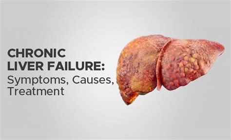 Chronic Liver Failure Symptoms Causes Treatment