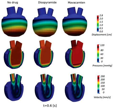 computational modeling on drugs effects for left ventricle in cardiomyopathy disease