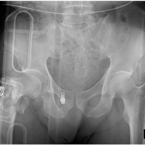 Judet Letournel Classification Of Acetabular Fractures Into Five