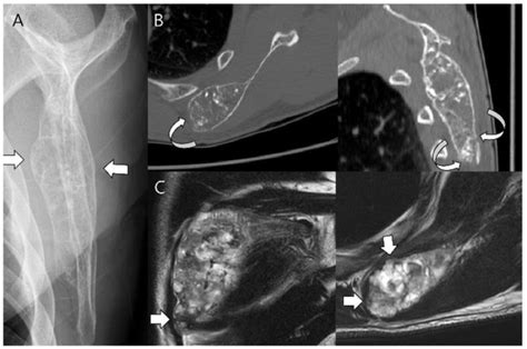 Classification Of Chondrosarcoma From Characteristic To Challenging