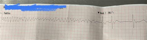 V Fib Or Torsades R Ekgs