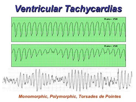 Image Result For Monomorphic Ventricular Tachycardia Vs Polymorphic