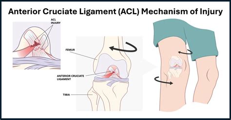 Anterior Cruciate Ligament Injury Acl Injury Knee Education