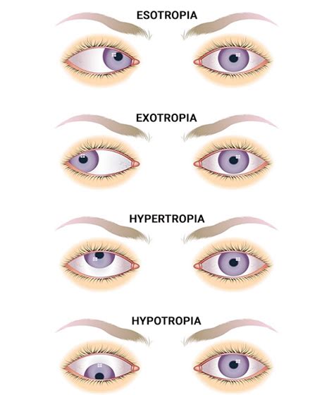 Amblyopia Lazy Eye In Nyc Ivy League Award Winning Doctors