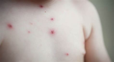 Maqedonia Shpall Epideminë E Fruthit Abc News