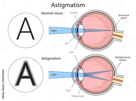 Astigmatism Disorder Medical Structure Diagram Hand Drawn Schematic