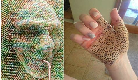 What Is Trypophobia Causes Symptoms And Treatment