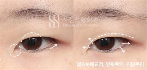 쌍꺼풀절개 흉터와 붓기는 얼마나 Doctors Note 눈재수술 시선성형외과