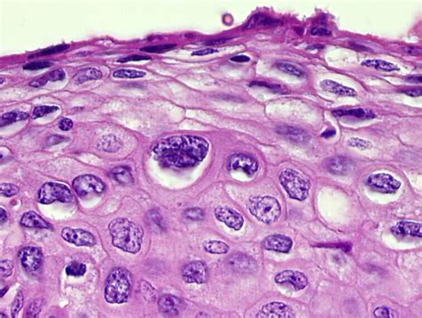 Koilocytes Histology Koilocytosis The American Journal Of Pathology
