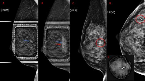 Preoperative Localization Of Breast Lesions Comparing Digital Breast