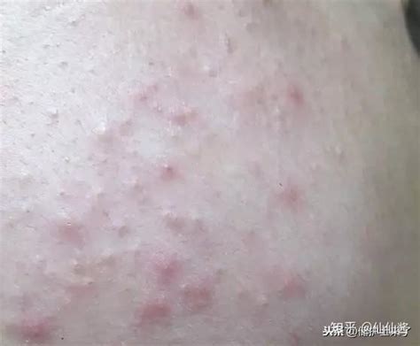 下巴上的白色颗粒去不掉到底是什么 知乎