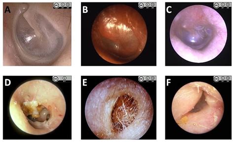 External Ear And Middle Ear A Normal Tympanic Membrane Original
