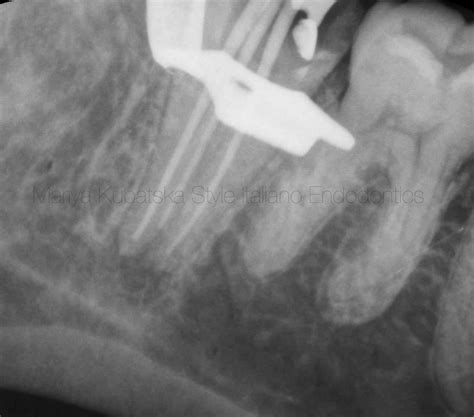Danger Zone In C Shaped Root Canals Style Italiano Endodontics