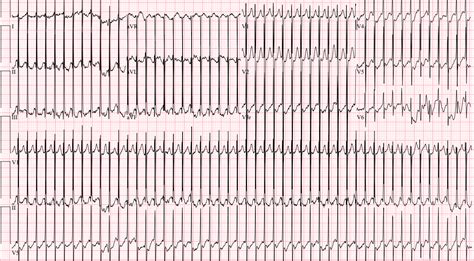 Neonatal Tachycardia By Dr Edward Guo Em Daily