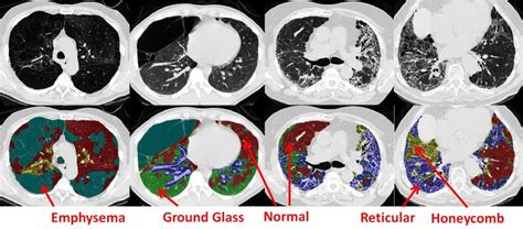 Examples Of Ild Patterns Every Voxel In The Lung Region Is Labeled As