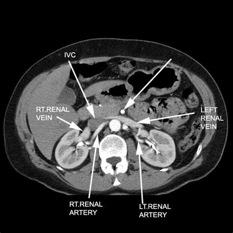 Inferior Vena Cava