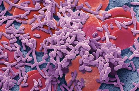 Cholangitis What Is Cholangitis