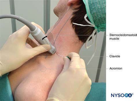 Ultrasound Guided Interscalene Brachial Plexus Nerve Block Nysora