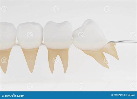 Dental Impacted Tooth Inflammation Stock Illustration Illustration Of