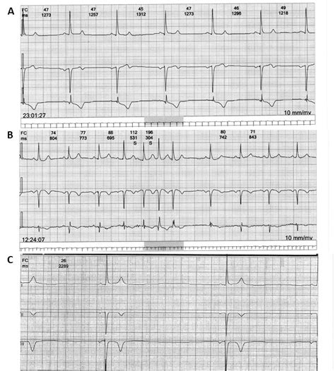Ab The 24h Holter Monitoring Showing Persistent Sinusal Bradycardia