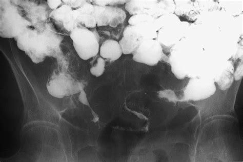 Chronic Radiation Enteritis Clinical Oncology