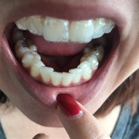 Day One My Teeth Arent Super Crooked” Because Ive Had Braces Many
