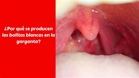 ¿por Qué Se Producen Las Bolitas Blancas En La Garganta Youtube