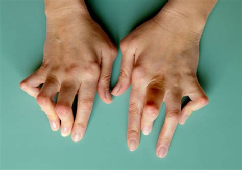 손가락 류마티스 관절염 증상 및 원인 손 관절이 붓고 통증 심하다면 의심해보세요