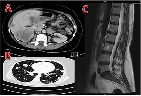 Choriocarcinoma Metastases Into Internal Organs A The Liver Shows