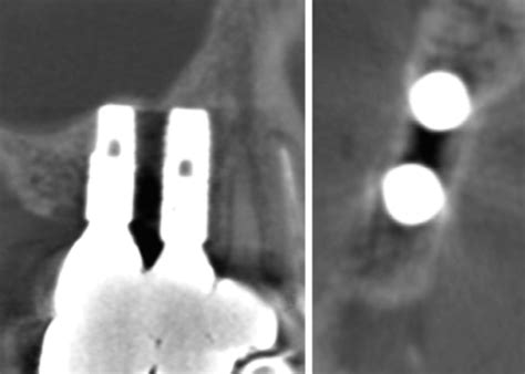 Bone Resorption Is Prominent Between 15i And 16i With Internal Download Scientific Diagram