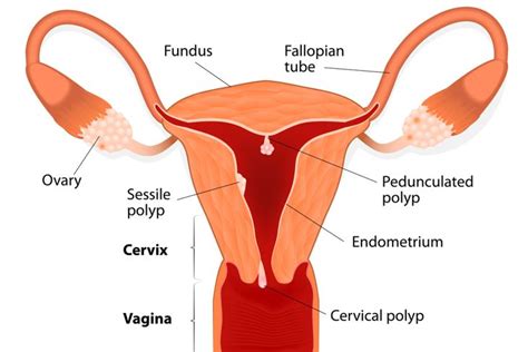 Common Polyp Types Health Detox Vitamins