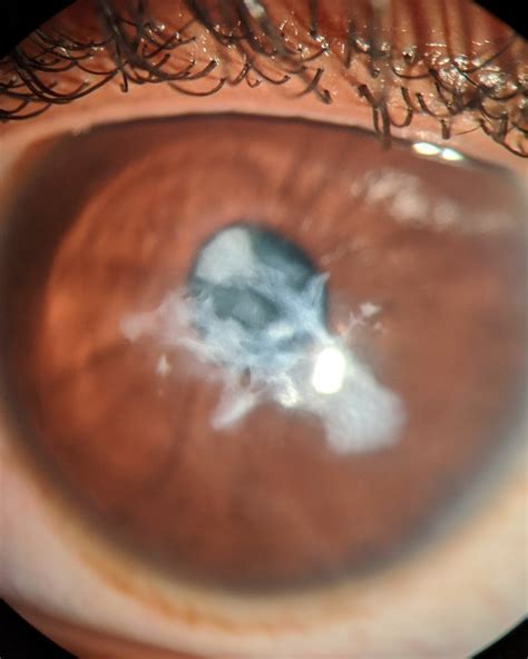 Jimmy Hu Md Ophthalmologist Eye Doctor Cataract Cornea And